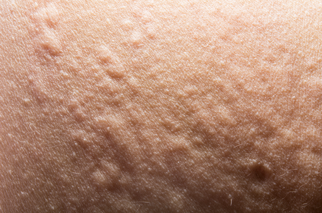 Hidradentitis Suppurativa Treatment Guide | Bronx, NYC