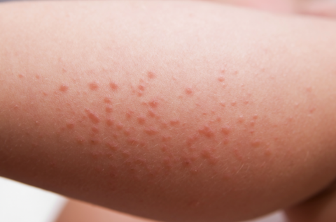 Poison Ivy, Oak, and Sumac Treatment Options | Bronx, NYC