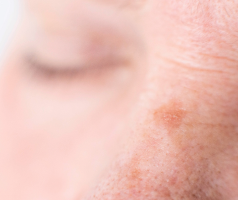 Age Spots | Brown Spots | Dermatology | Bronx, NYC
