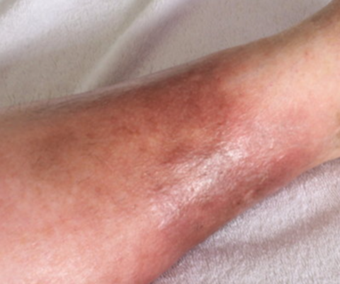 Cellulitis | Dermatology & Surgery Associates